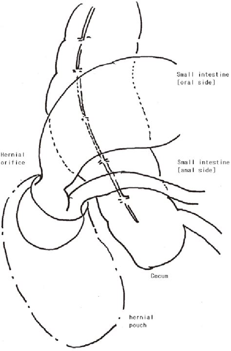 Figure 1 From Small Bowel Obstruction Due To Paracecal Hernia On The