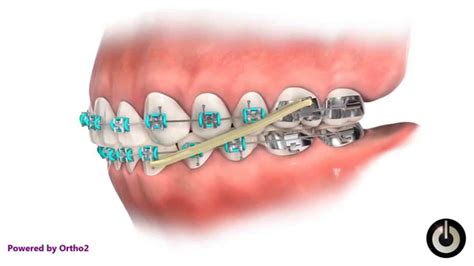 Class Iii Elastics Youtube