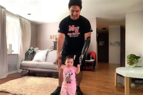 Elective Amputation Of An Upper Limb