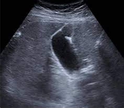 Abdomen Liver Gb Bile Ducts Review Flashcards Quizlet