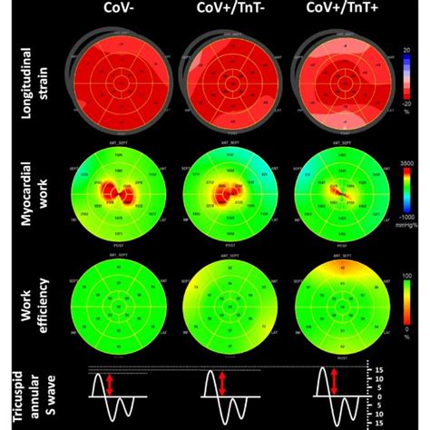 Bulls Eye Representation Of Longitudinal Strain Myocardial Work Download Scientific Diagram