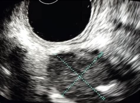Radial Endoscopic Ultrasound Shows A Round Hypoechoic Mass Located In