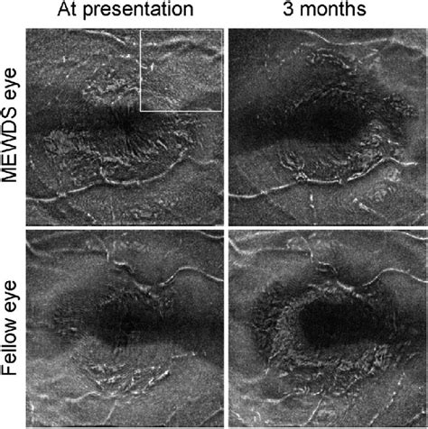 Structural En Face Octa Projections In Case 3 Taken At Presentation And Download Scientific
