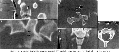 Table 1 From Fractures Of The C 2 Vertebral Body Semantic Scholar