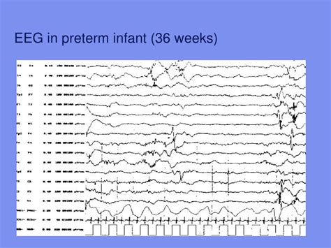 Ppt Cerebral Function Monitoring Amplitude Integrated Eeg Aeeg