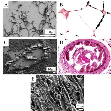 Different Skin Calcification Localisation Calcification In The