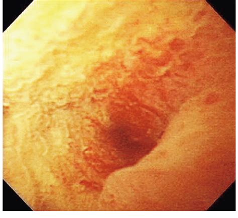 Hilar Cholangiocarcinoma Showing Peripheral Infiltrative Growth Type Download Scientific