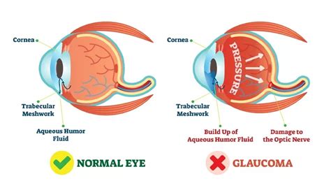 Glaucoma Management Best Glaucoma Hospital In Mumbai And Navi Mumbai