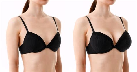 Orlando Breast Lift Scars Visibility And Healing Explained