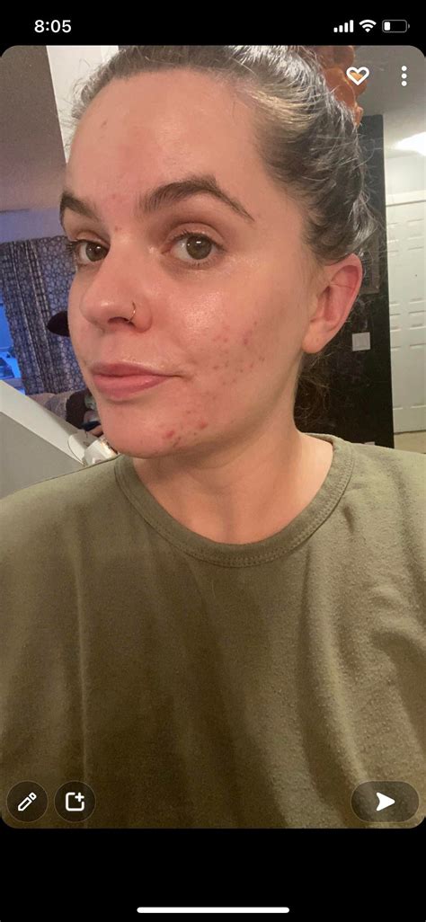 Before And After Rtretinoin