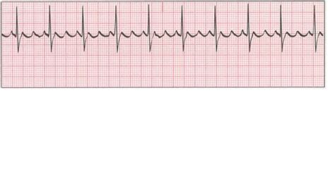 ekg strips flashcards quizlet