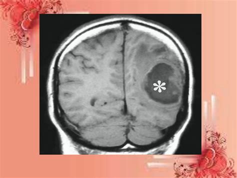 Brain Abscesspptx