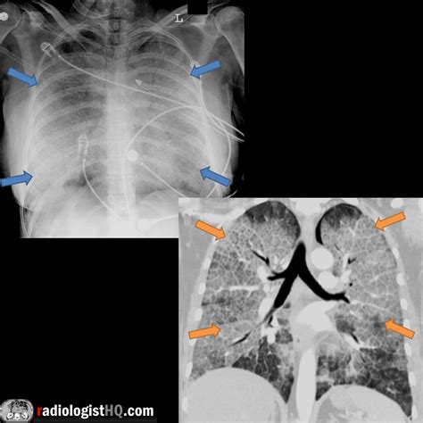 Pulmonary Alveolar Proteinosis With Crazy Paving On Ct Radiology