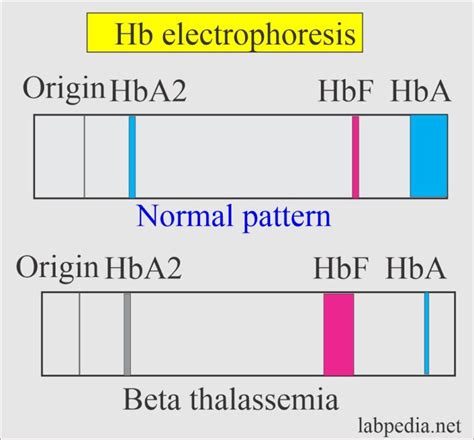 Anemia Part 4 Thalassemia Discussion And Work Up