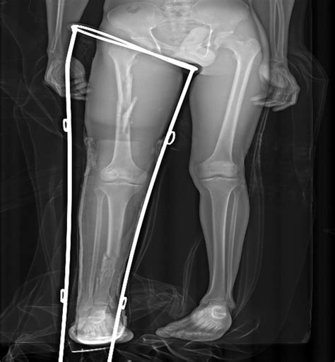 Skeletal Traction Femur Fracture