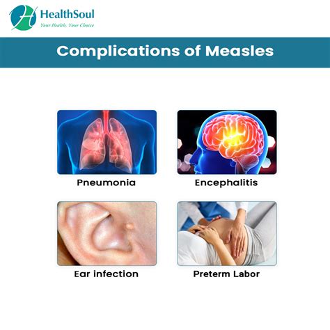 Measles Symptoms And Treatment Healthsoul