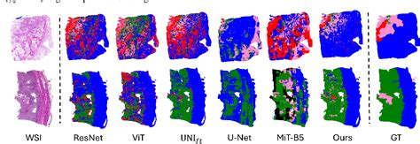 Bridging Classification And Segmentation In Osteosarcoma Assessment Via Foundation And Discrete