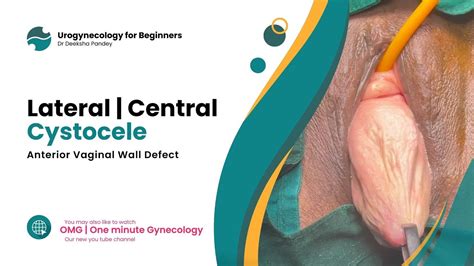 Lateral Versus Central Cystocele Types Of Cystocele Paravaginal Defect Youtube