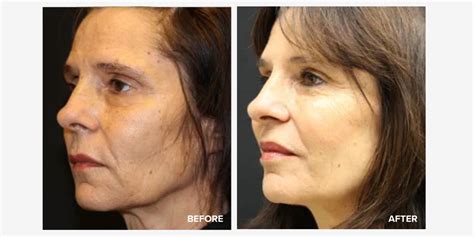 6 Best Sculptra Before And After Photos Realself News