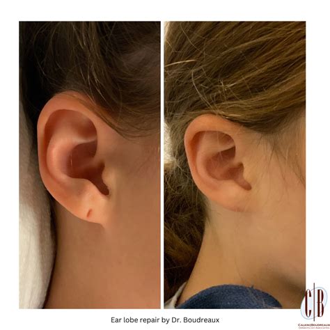 Earlobe Repair Calkin And Boudreaux Dermatology Associates