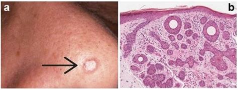 Infundibulocystic Basal Cell Carcinoma A Skin Lesion B Histology