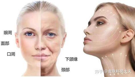 抗衰新选择——5d胶原光（附疗后注意事项） 知乎