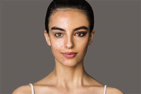 Acne Myths Vs Facts I Corporate Review Blog