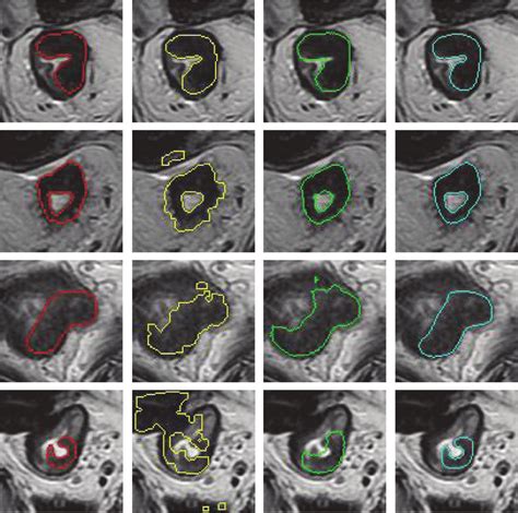 Rectal Tumors Segmentation In T2w Mri Images Rows 1 4 Were Different Download Scientific