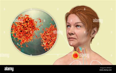 Thyroid Gland Cancer With Closeup View Of Cancer Cells Computer