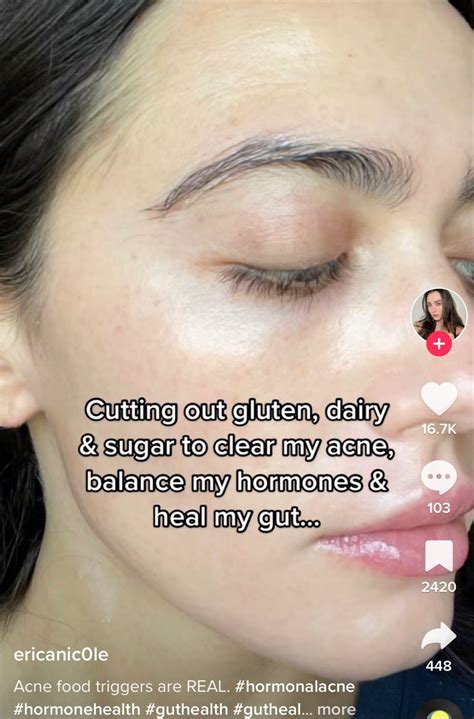 Pcod Vs Pcos Artofit