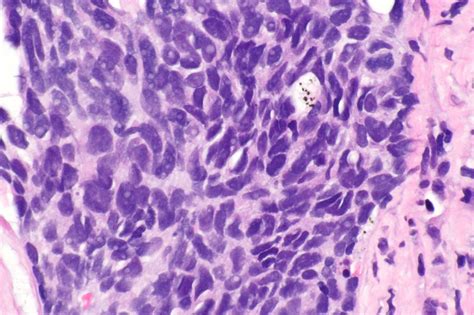 Fda Approves Mobocertinib For Egfr Exon 20 Insertionmutated Nsclc