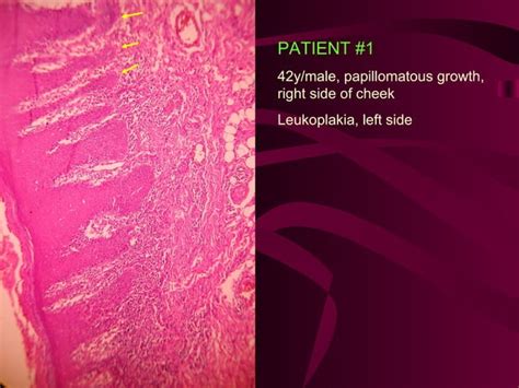 Podoplanin And Its Role In Diagnosis Of Cancer Invasion Ppt