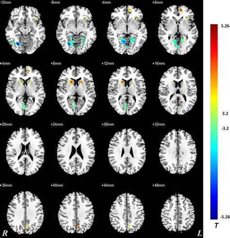 Alff Values Using Two Sample T Tests During Resting State Decreased