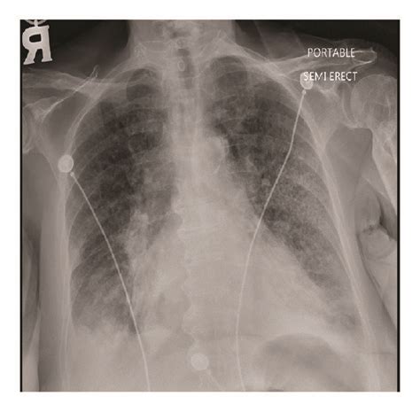 A Cxr On Admission Showing Bilateral Small Pleural Effusions And