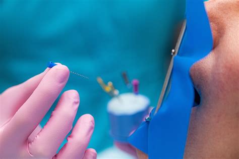 Premium Photo An Endodontist Preparing Barbed Broach For Endodontic