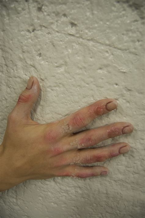 Mild Frostbite
