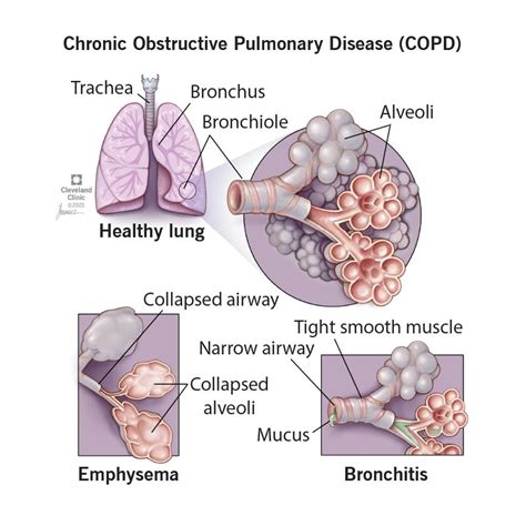 What Is Chronic Obstructive Pulmonary Disease Copd Artofit