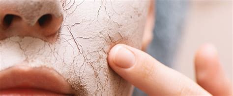 3 Tips To Remove Acne Scars From Buttocks Naturally