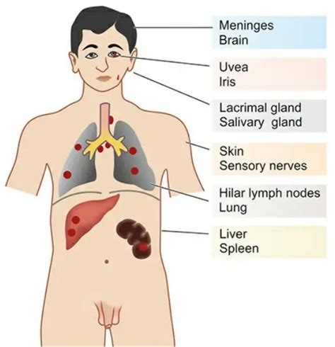 Actinomycosis Etiology Clinical Features Diagnosis Notes Anatomy