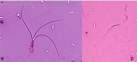 Sperm Abnormality Observed Under Phase Contrast Microscope 200x A