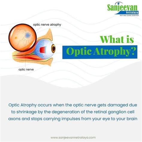 What Is Optic Atrophy Optic Atrophy Occurs When The Optic… By Sanjeevan Netralaya Medium