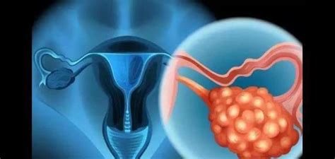 有一种腰痛可能是癌症的信号，很多人发现就是晚期，别不当回事儿