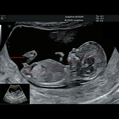 Diagnostic Du Sexe Fœtal à Léchographie Quand Et Comment