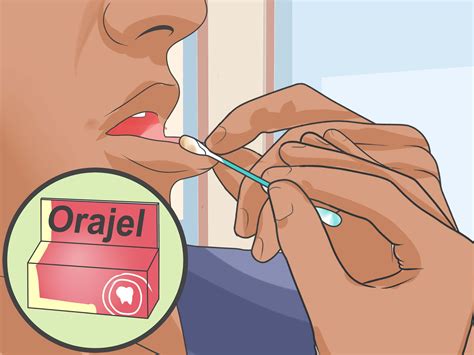 How To Cut Off Braces Wire At Armando Mendoza Blog