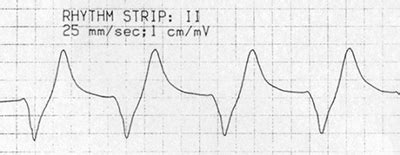 Hyperkalemia Ecg