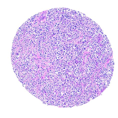 Lymphoma Tumour Tissue Microarray Mymab Biologics