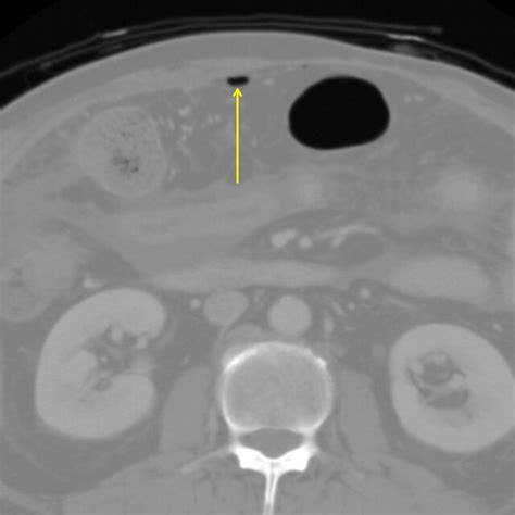 Ct Imaging Findings Of Fluid Collection In Peritoneal Cavity Arrows