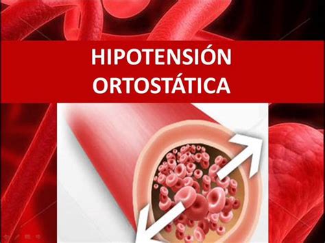 Todo Lo Que Necesitas Saber Sobre La Hipotensión Ortostática Causas