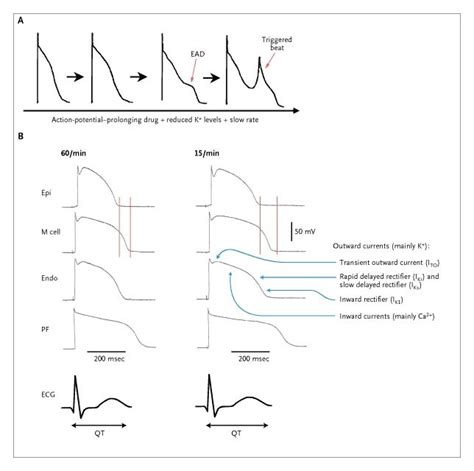 What Is Drug Induced Qt Prolongation At David Clinton Blog