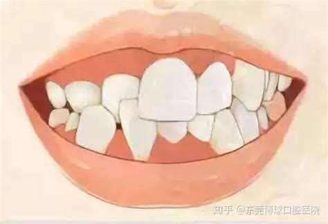 知识科普有一种影响面部美观的问题叫错颌畸形 知乎